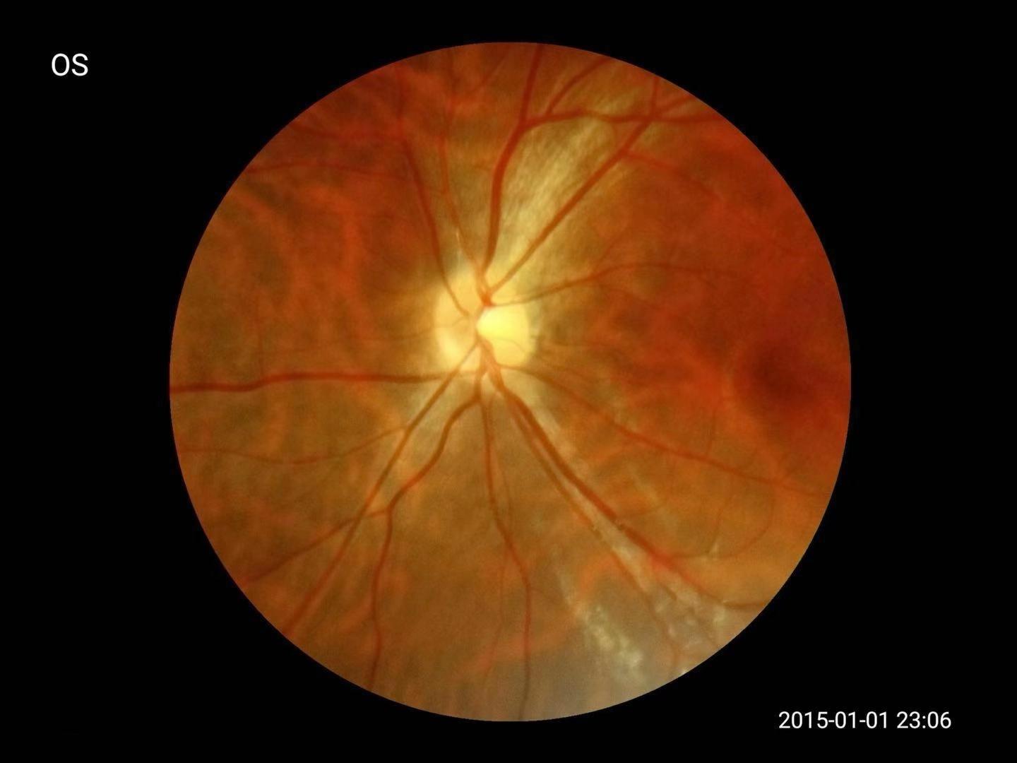 High Definition Imaging Ophthalmic Instrument Digital Portable Hand ...