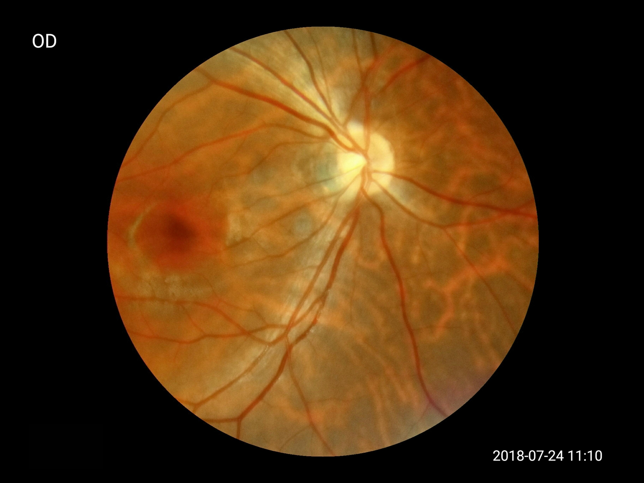 High Definition Imaging Ophthalmic Instrument Digital Portable Hand ...