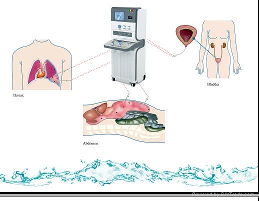 Intraperitoneal hyperthermic Chemoperfusion - GDPR-2100T - Gooddoctor ...