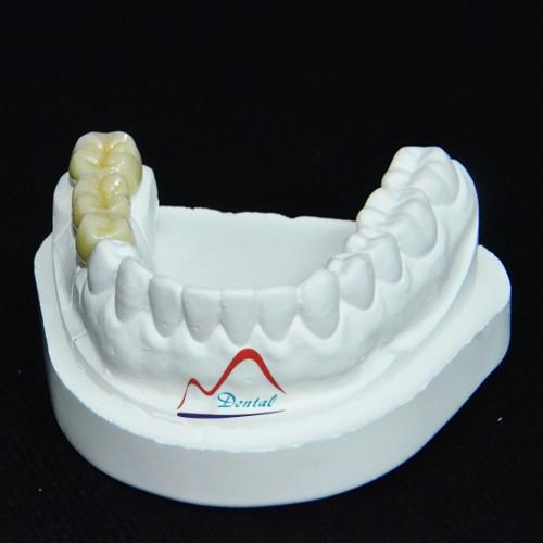 Full Contour Zirconia Crown and Bridge - AC038 (China Trading Company ...