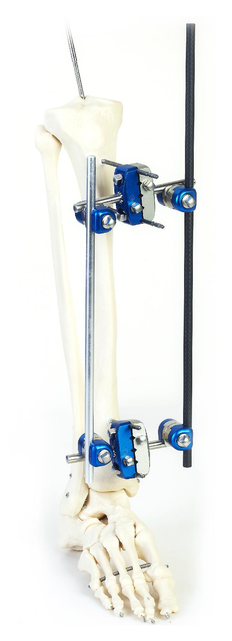 SK Combined External Fixator(Large Bone) - Zener (China Manufacturer ...