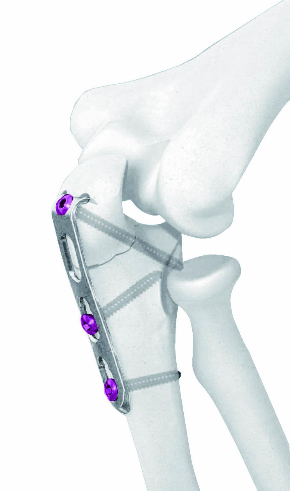 Olecranon hook locking plate - Placa LCP de gancho 3.5mm para olecranon ...