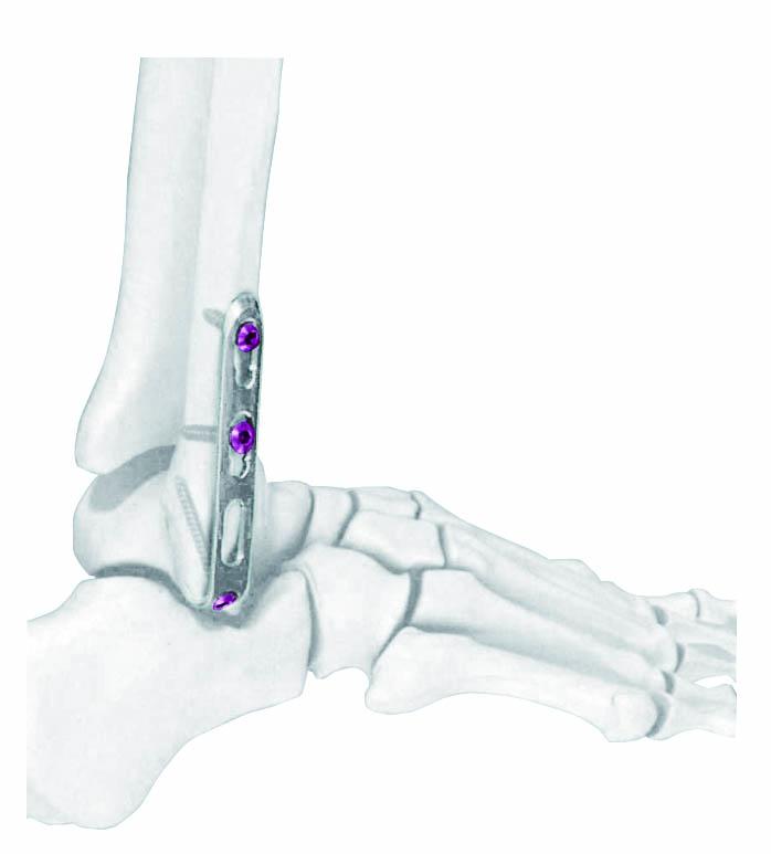 Olecranon hook locking plate - Placa LCP de gancho 3.5mm para olecranon ...