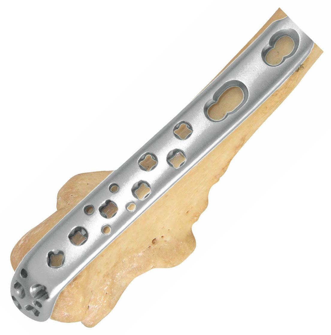Ulnar olecranon universal locking plate II(Variable Angle) - 2102 - JZ ...