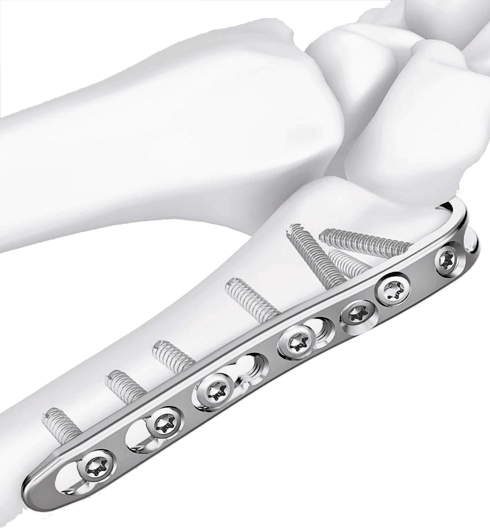 Distal Ulnar hook LOC plate - Placa LCP de gancho para cúbito distal ...