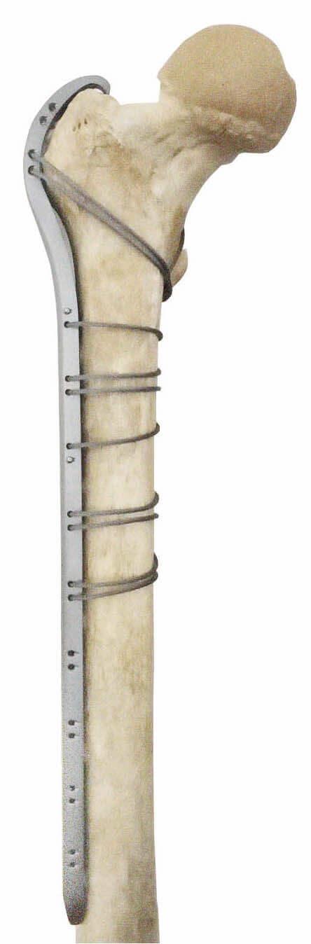 Periprosthetic proximal femoral lateral hook plate III-Placa de gancho