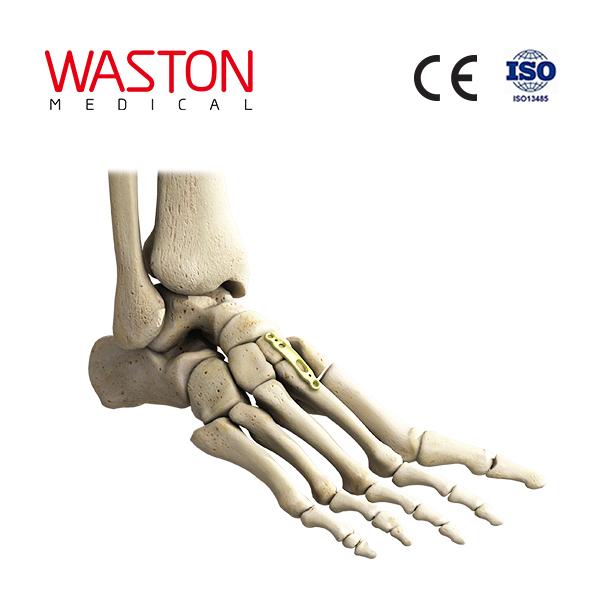 Implants Foot Orthoses Orthopaedics CE Metatarsal cuneiform joint ...