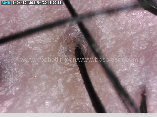 10X-200X Hair and Scalp Camera（1.3 pixels） - CBS-603 - CBSHOTLINE ...